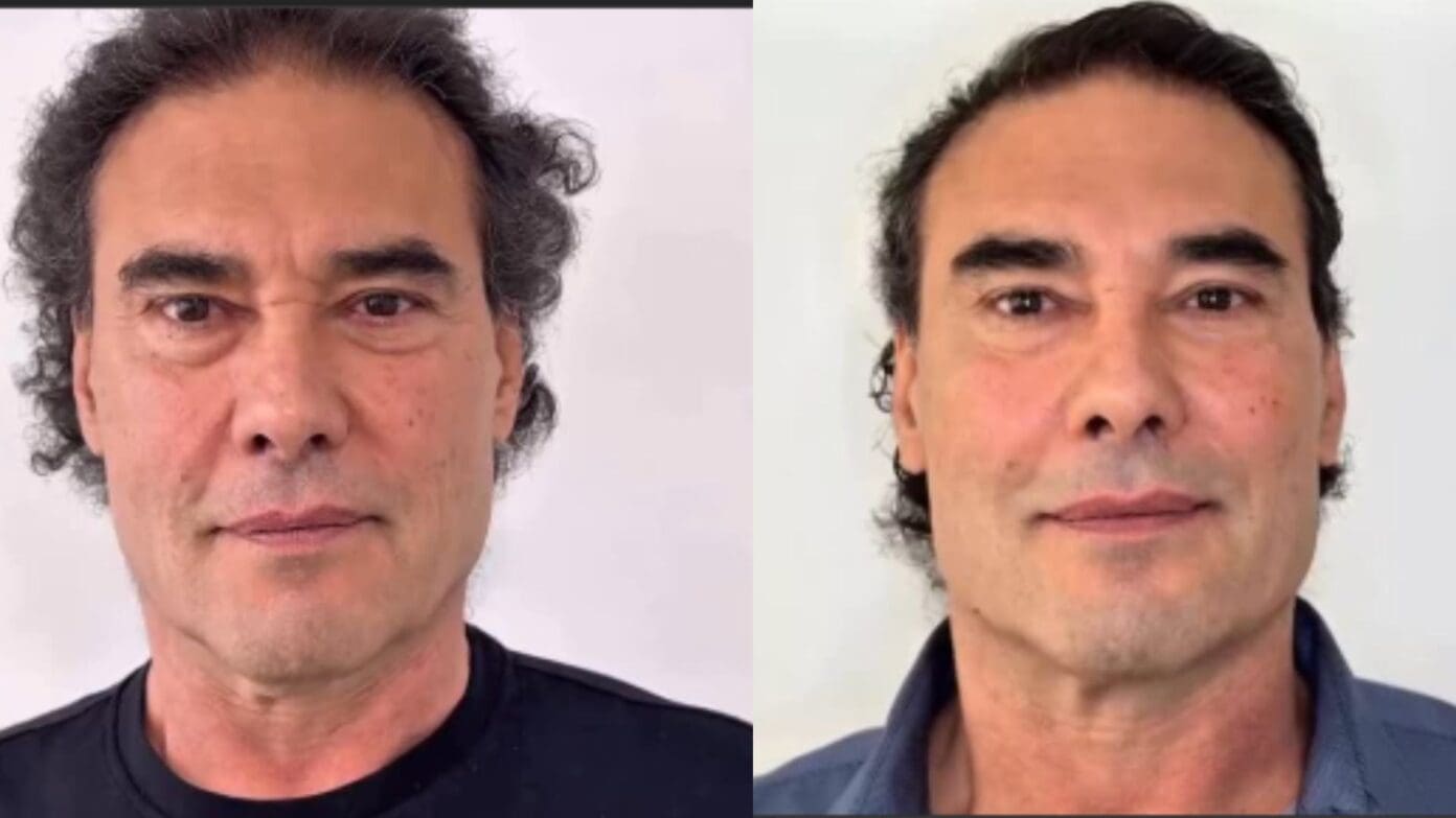 Actor Eduardo Yáñez se somete a cirugía de rejuvenecimiento facial y ...